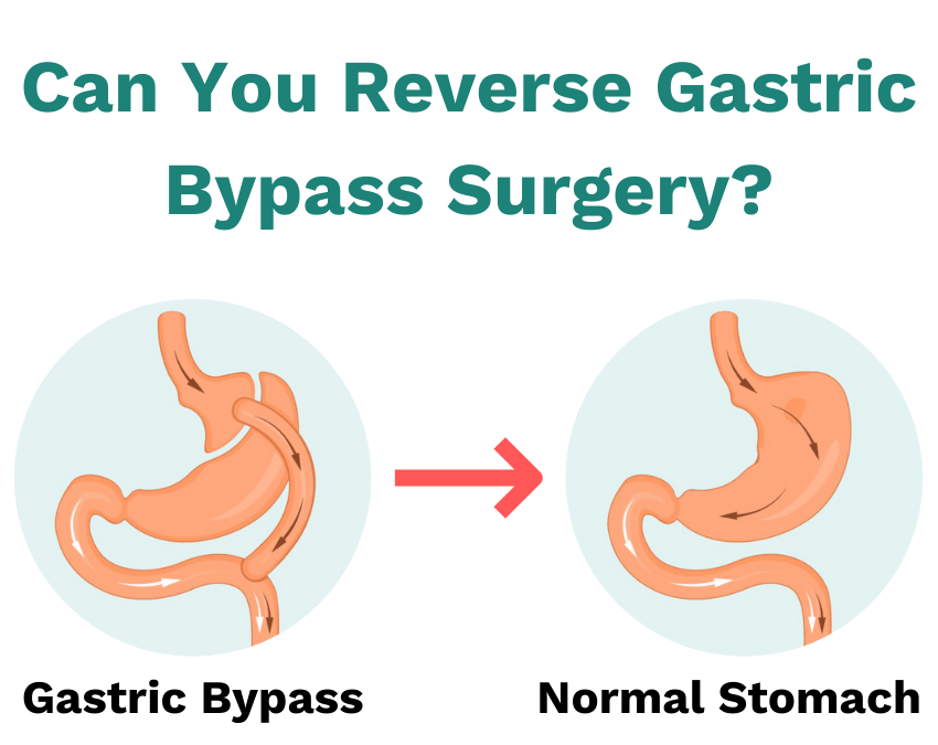 Gastric Bypass Reversal